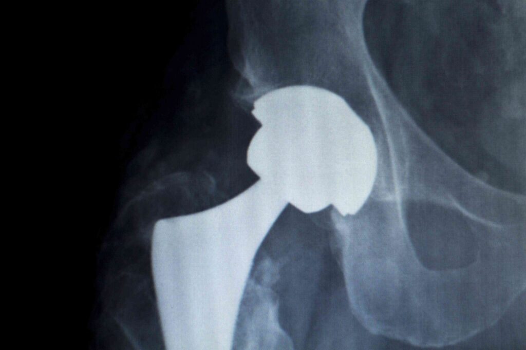 Hip Replacement | Bucks County Orthopedic Specialists